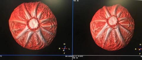 SWI序列原理及临床应用 - 知乎
