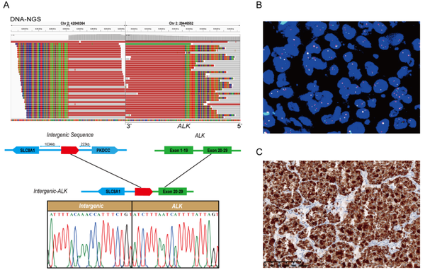 文章发表 | 案例报道：NGS检测指导罕见Intergenic-ALK基因融合肺腺癌患者临床精准治疗 - 知乎