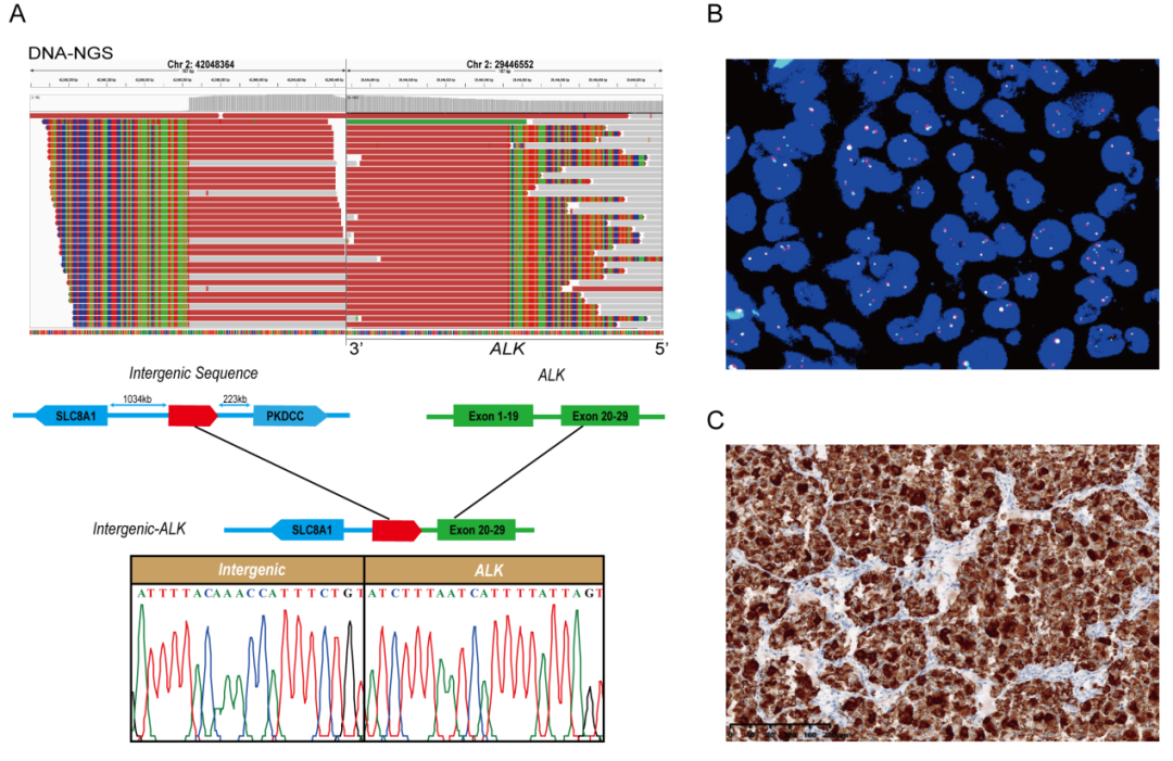 文章发表 | 案例报道：NGS检测指导罕见Intergenic-ALK基因融合肺腺癌患者临床精准治疗 - 知乎