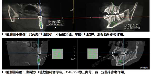 伯爵CBCT影像篇 ⑤：CBCT影像认知 - 知乎