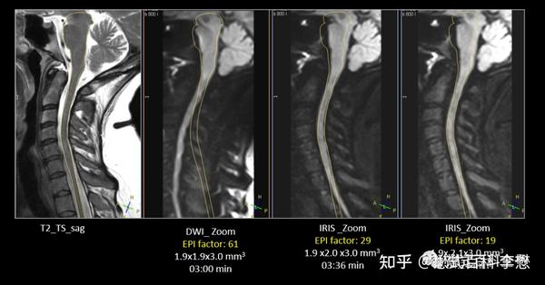 IRIS：多激发SE-EPI扩散（弥散）序列 - 知乎