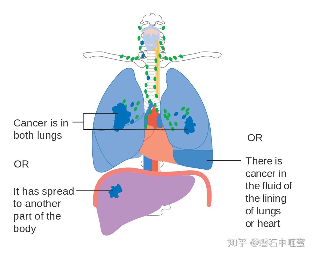 肺癌 Lung cancer - 知乎