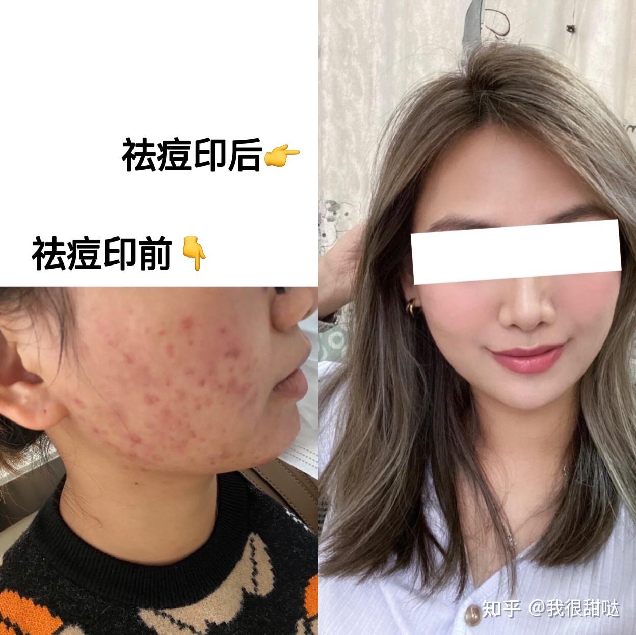 纯干货教你如何消除红色痘印、黑褐色痘印,都给我看!! 知乎