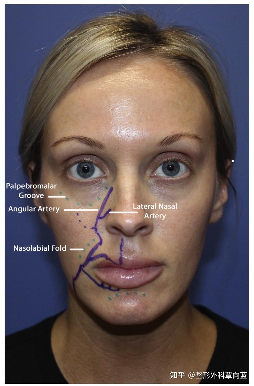 基于SMAS韧带的注射指导，即所谓的“True Lift”注射技术 - 知乎