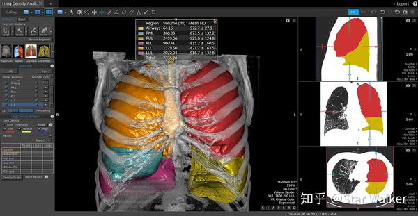 关于影像后处理工作站的点滴分享——肺部CT密度分析 - 知乎