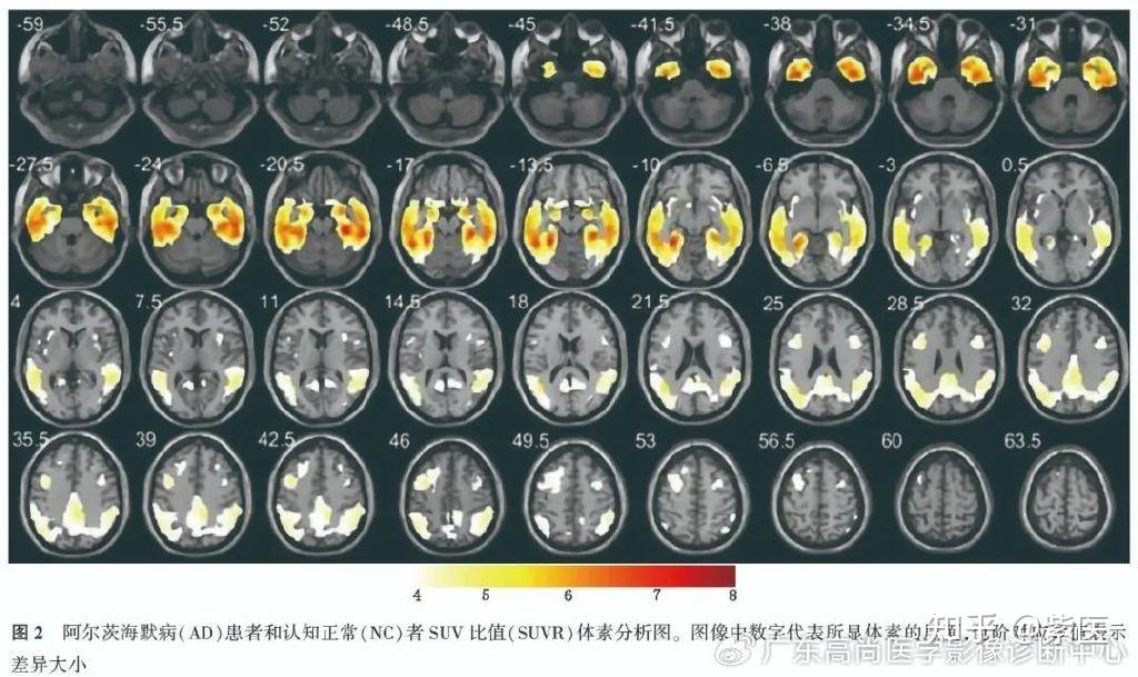 阿尔茨海默病中tau蛋白的18F-MK6240 PET显像研究及认知相关分析 - 知乎