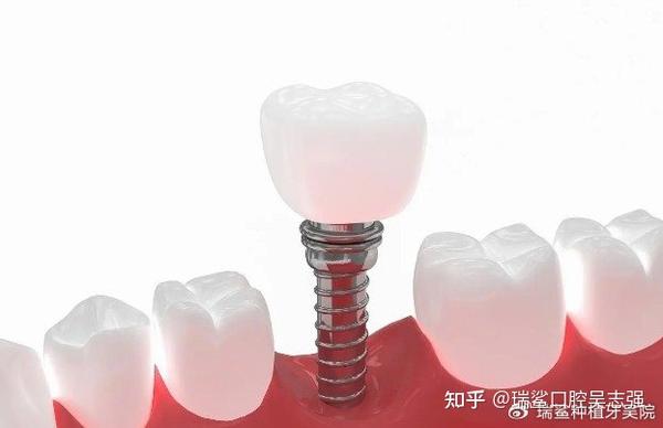 北京瑞鲨舒适口腔丨如何选择种植牙的材质？听听良心老牙医的建议！ - 知乎