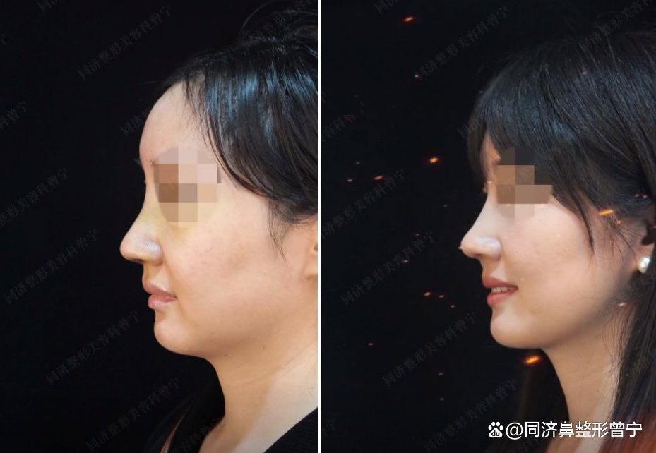 鼻子塌、鼻基底凹陷做手术多少钱一次,多久消肿恢复正常? 知乎