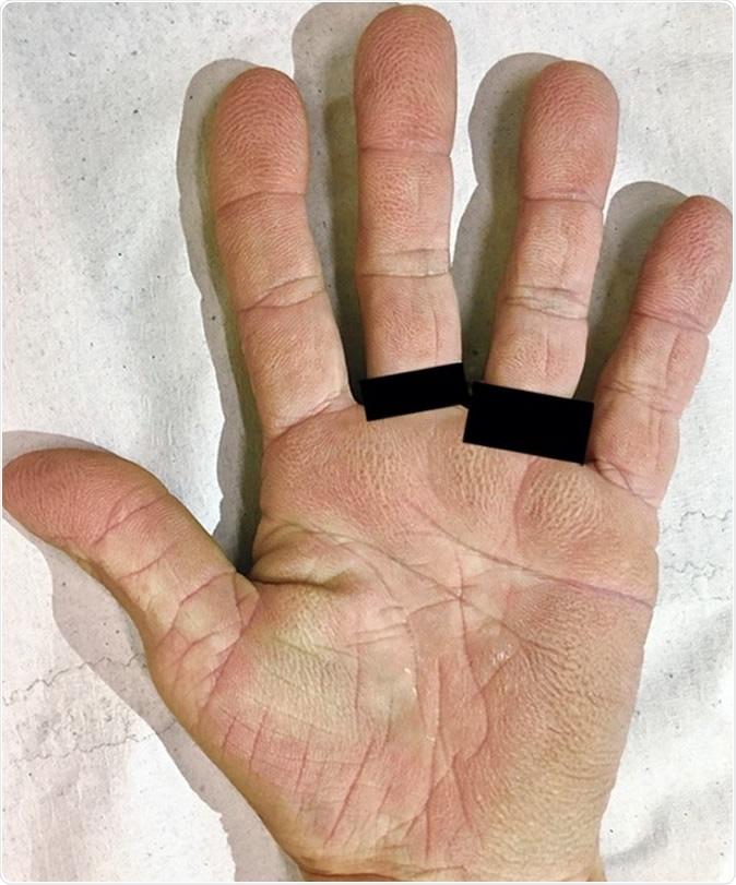 赴美医疗 女人的手心出现这种情况可能是肺癌的征兆 - 知乎