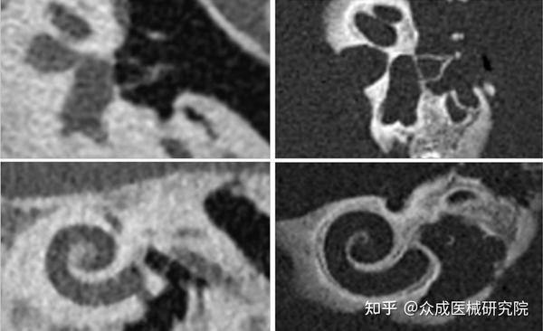 光子计数时代，西门子NAEOTOMAlpha颠覆传统CT局限，东软提前布局 - 知乎