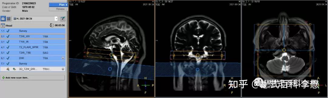 MRI内听道神经及周围血管成像扫描规范（MRTA、IAC） - 知乎