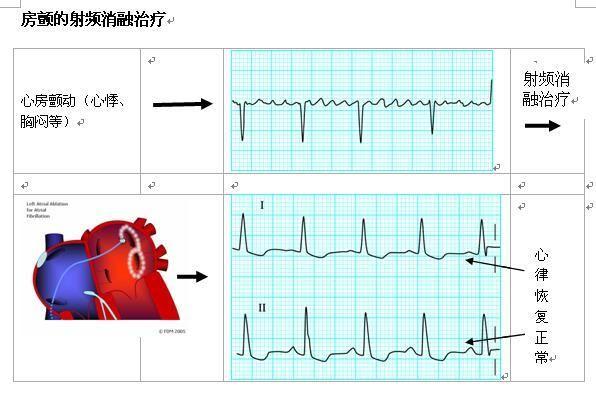 创新！S-CATH™ M房颤导管消融产品获FDA批准 - 知乎
