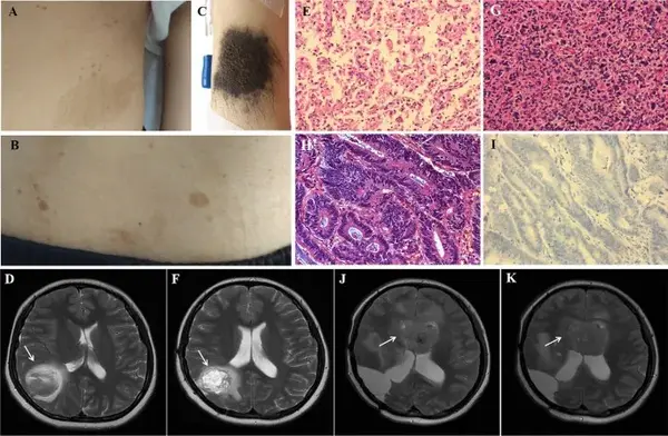 #泛教授读文献# 二代测序助力结构性错配修复缺陷综合征（CMMRD）诊断 - 知乎