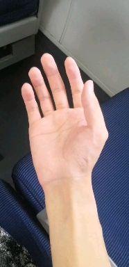 Tfcc患者的恢复 - 知乎