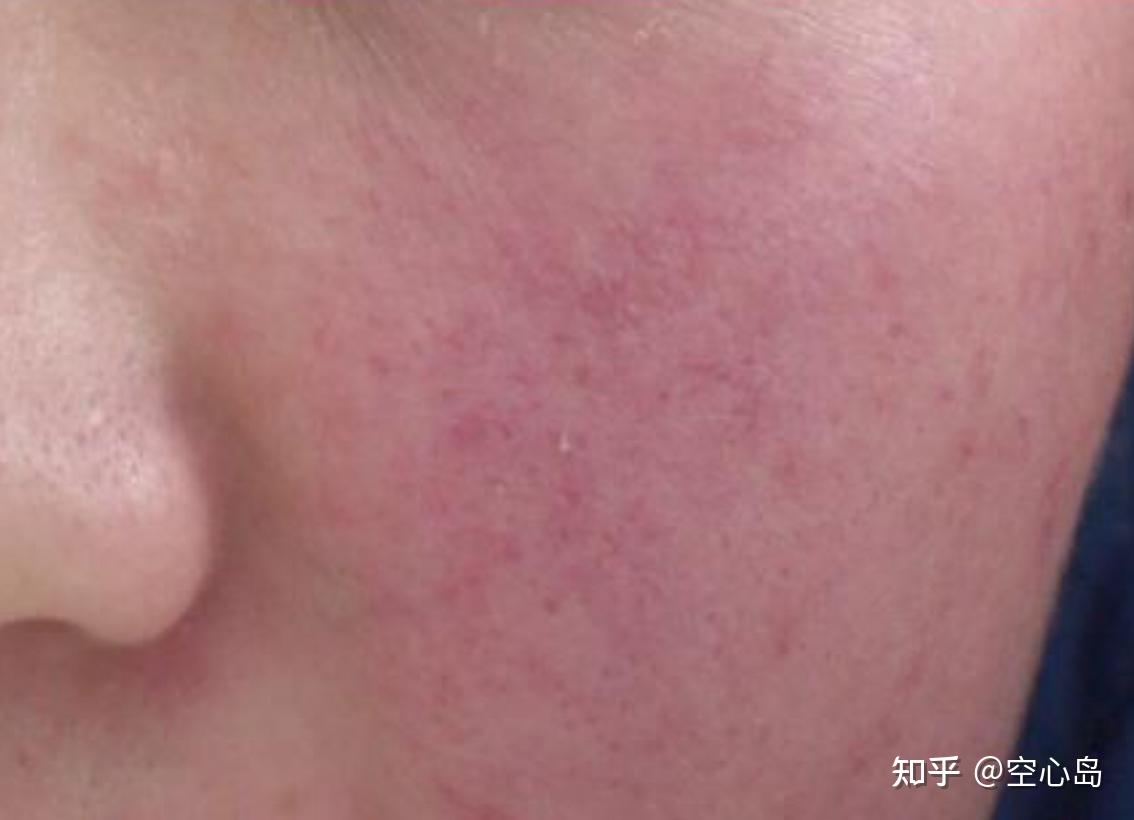 修复敏感肌时,你踩过哪些雷?有哪些值得分享的宝藏干货 知乎