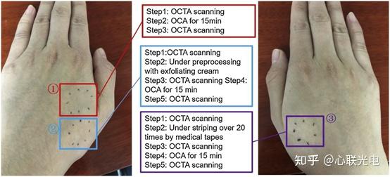 PHOTODIAGN PHOTODYN：光透明剂增强OCTA临床评估人体皮肤 - 知乎