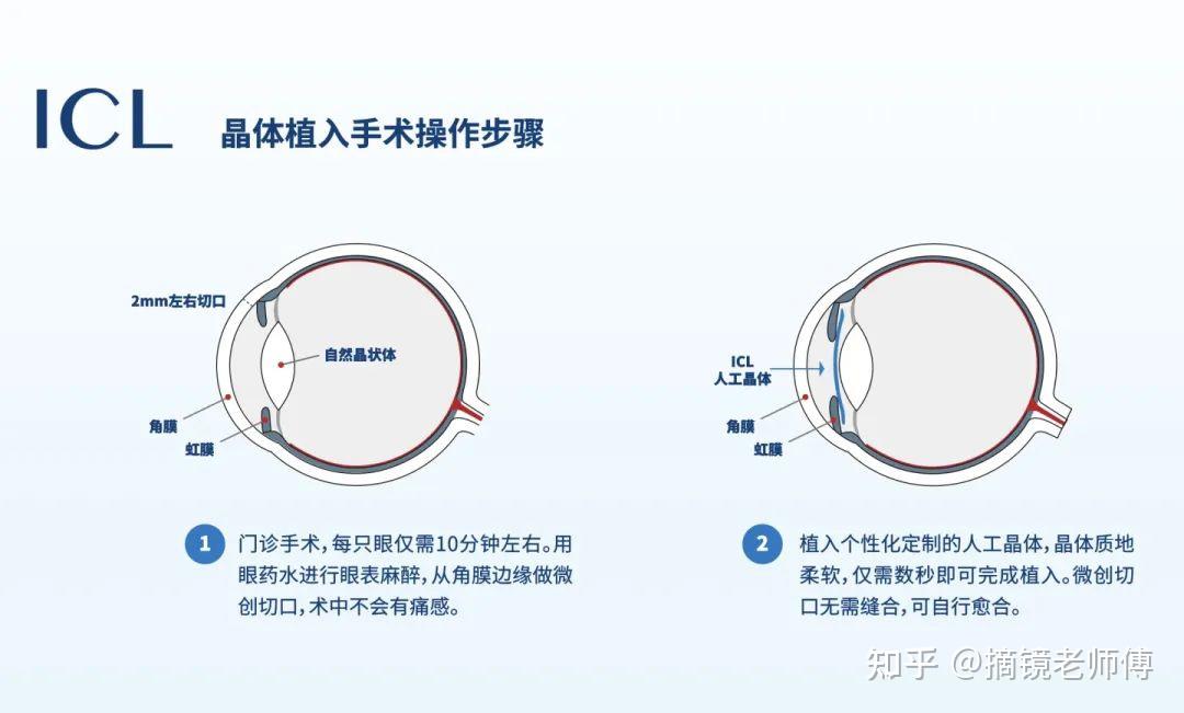 ICL晶体植入近视手术到底有多贵？ - 知乎