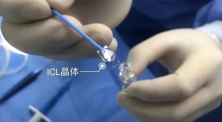 受欢迎的ICL晶体植入到底是什么？ - 知乎