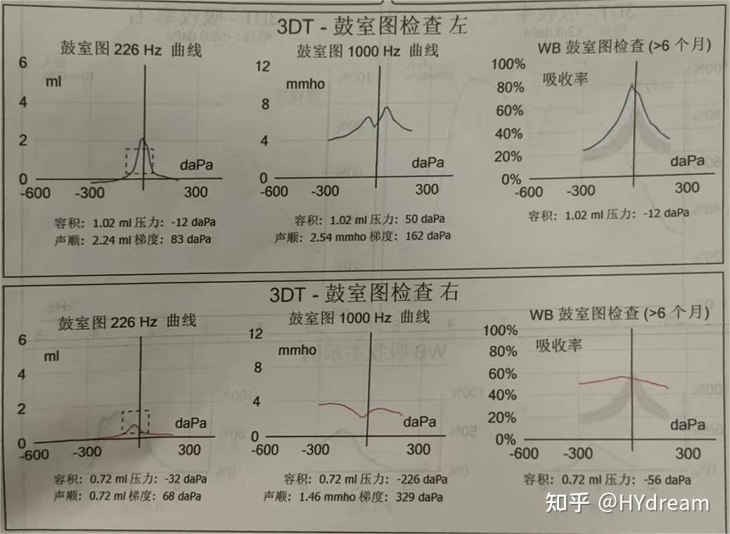 案例分享丨耳鸣案例 - 知乎