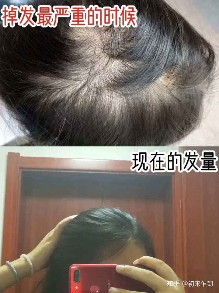 脂溢性脱发还能长吗？我的亲身经验分享 知乎