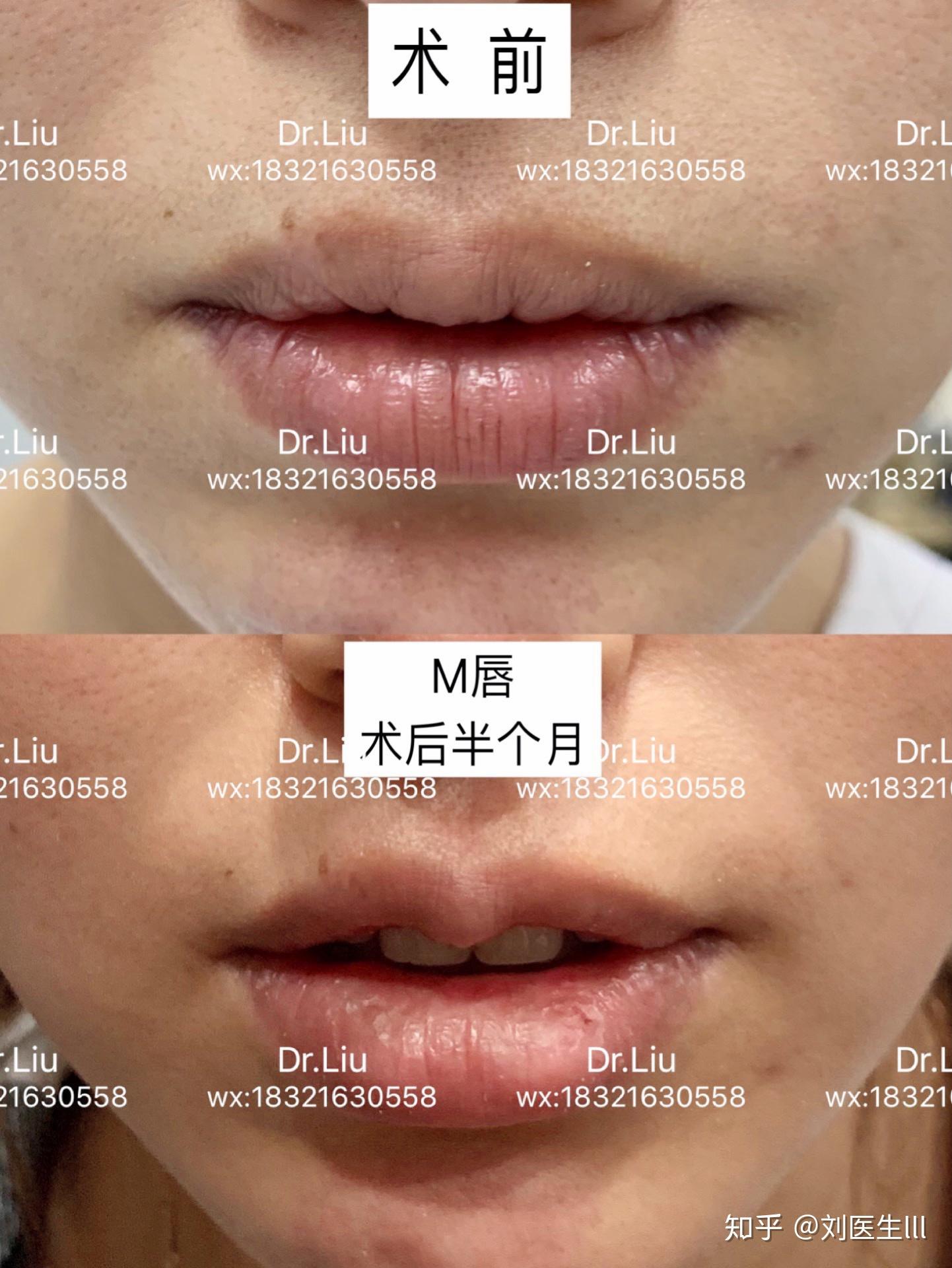 #唇综合# #花瓣唇# #微笑唇# #M唇# - 知乎