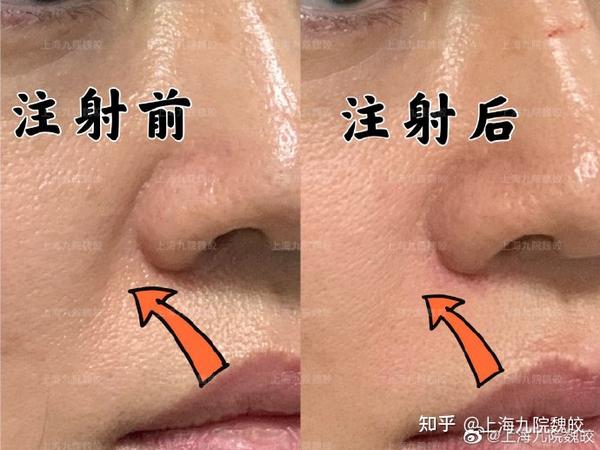 按摩就可以祛除法令纹?真有那么神奇吗? 知乎