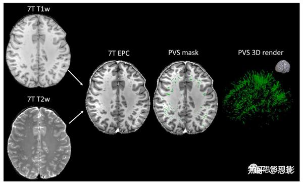 PVS：对血管周围间隙结构和功能的成像 - 知乎