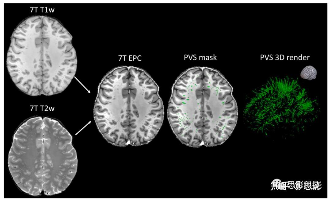 PVS：对血管周围间隙结构和功能的成像 - 知乎
