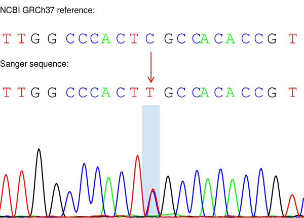 案例分享 | 罕见病基因诊断——先天性去糖基化障碍（NGLY1‐CDDG） - 知乎