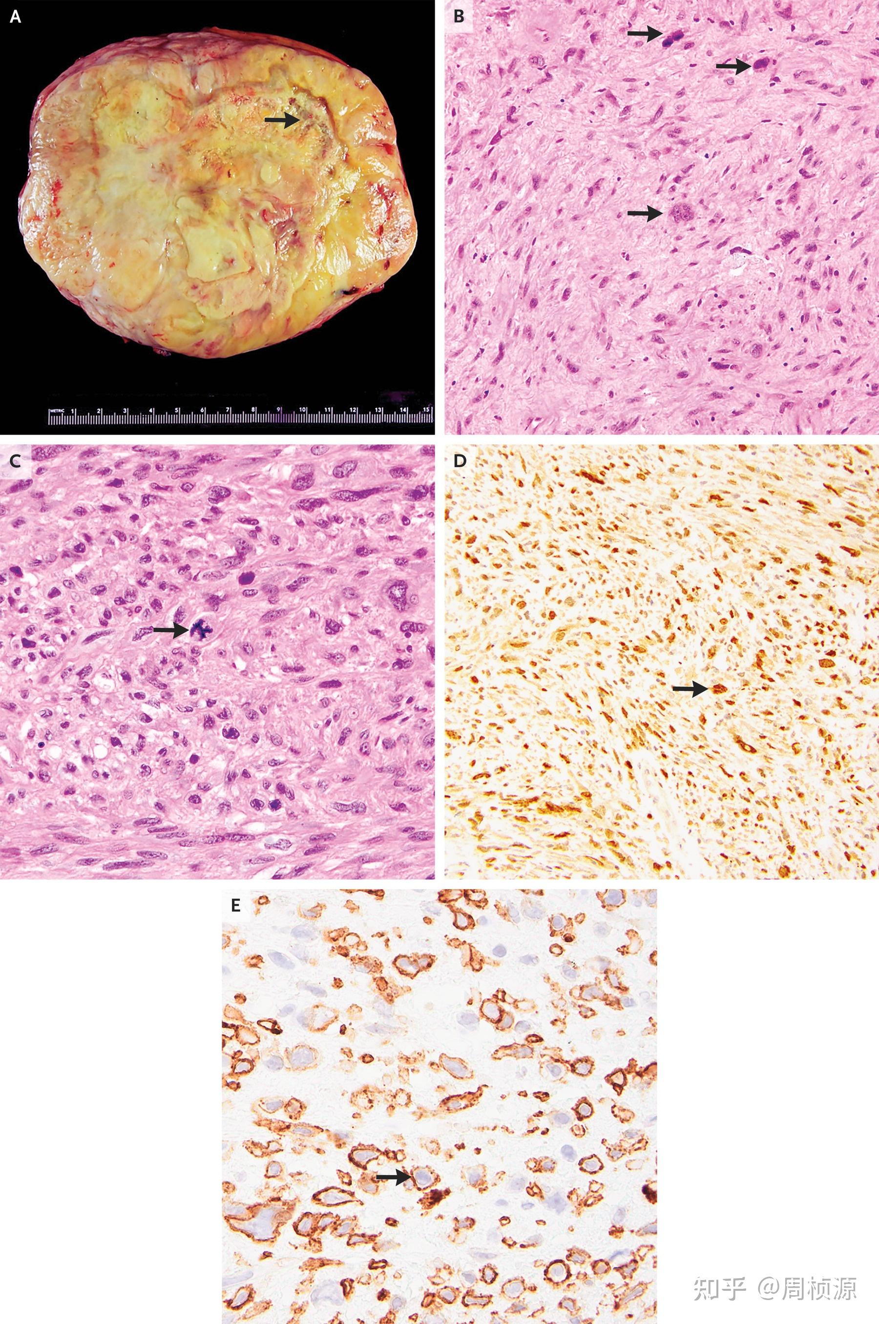 Nejm 2023 Case 20 - 知乎