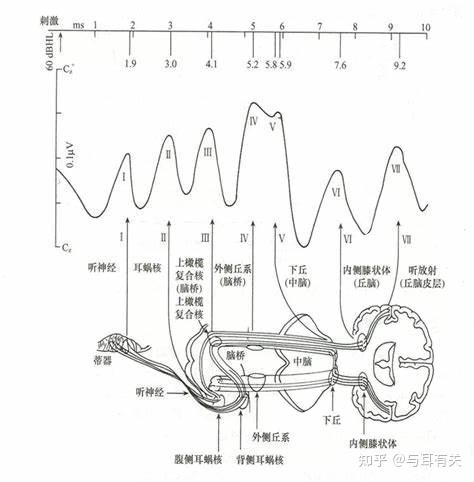 听性脑干反应(ABR) 操作方法、结果解读及临床应用 - 知乎
