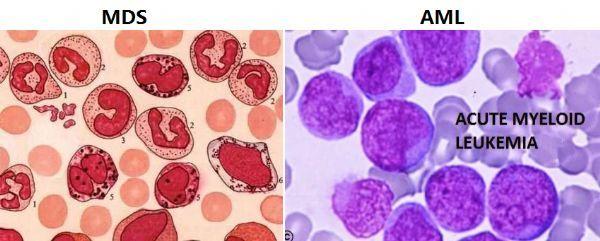 TP53突变型MDS和AML新药，eprenetapopt（APR-246）在研疗效显著 - 知乎