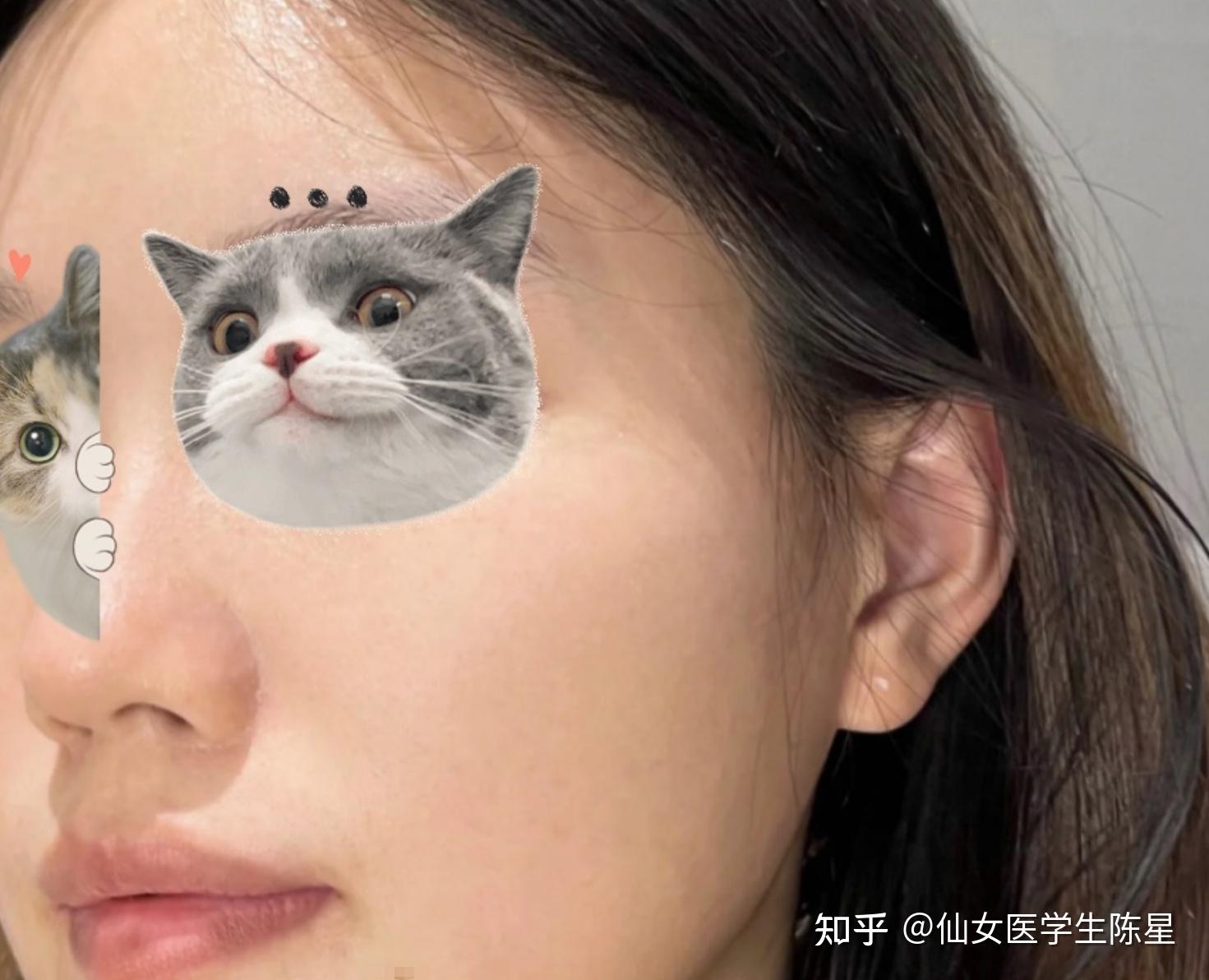1个月去痘印【专业医学硕士】教你最有效的去痘印方法,当你脸上被痘印爬满,遮瑕都掩盖不了,看完这篇彻底解救你的痘印脸! 知乎