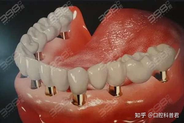 种牙与镶牙有什么区别哪个好一些，更想知道装牙装什么牙最划算 知乎