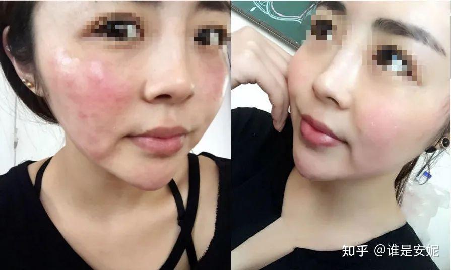 脸上有很多红血丝怎么办？脸上起了很多红血丝怎么办？ 知乎