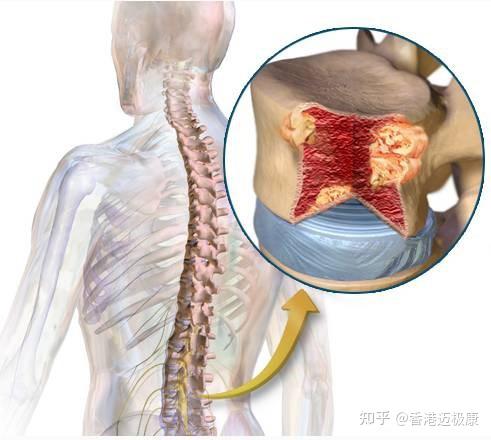 多发性骨髓瘤，辉瑞双特异性抗体Elranatamab获FDA优先审评 - 知乎