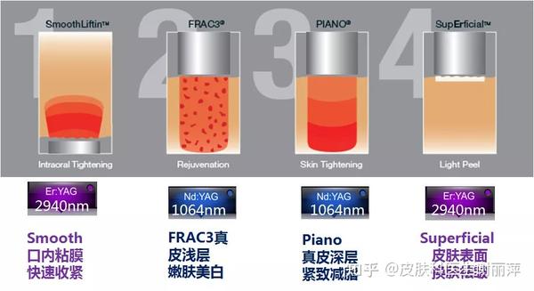 欧洲之星Fotona 4D 和Fotona 4D pro有什么区别?丨科普篇 - 知乎