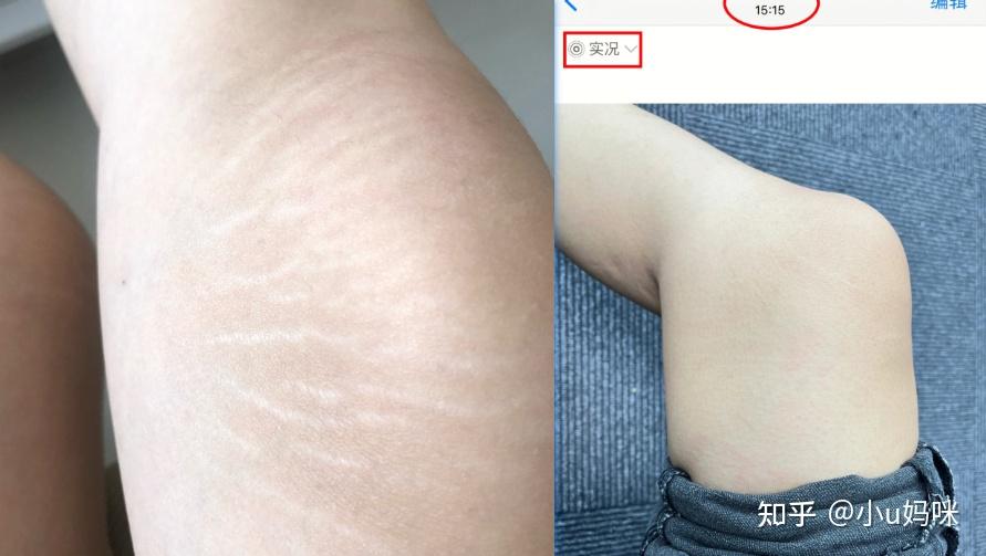 在大腿上5年的肥胖纹就这么淡化掉了!长在腿上太丑试试这个好用又惊艳淡纹方法,保让你赞不绝口! 知乎