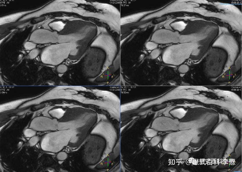 MRI图像扫描角度和图像方位问题探讨 - 知乎