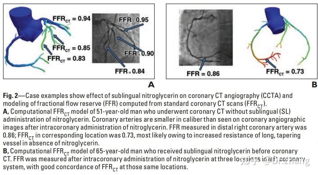 CCTA和CT-FFR的诊断性能：结果来自CCTA测定的血流储备分数（DeFACTO）研究 - 知乎