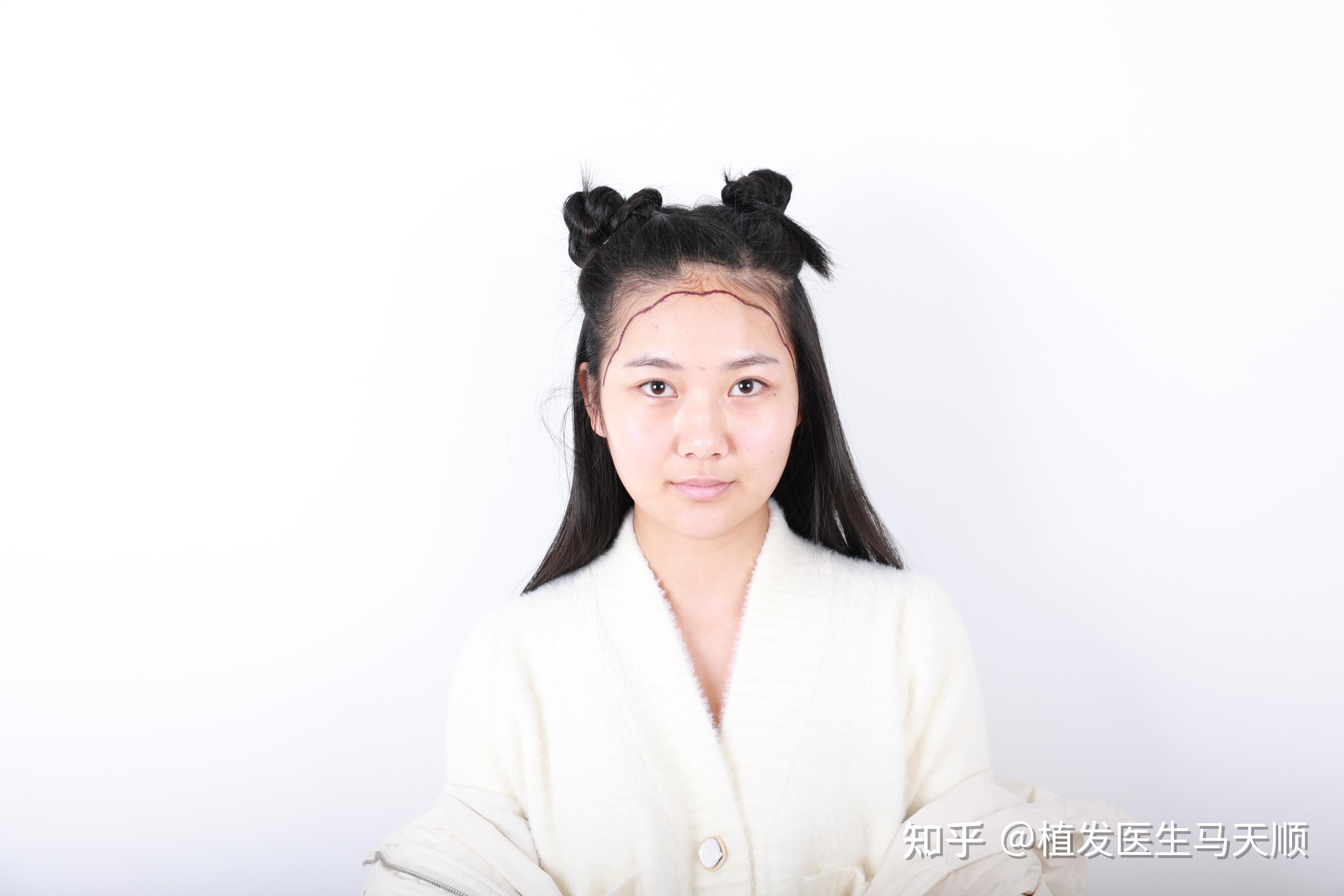 发际线可以长回来吗?发际线还会长回来吗发际线还能长出来吗?—探究发际线植发技术 知乎