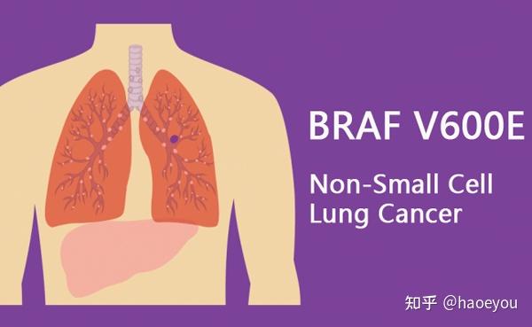 客观缓解率75%！BRAF V600E突变肺癌患者，迎来新型靶向联合疗法 - 知乎