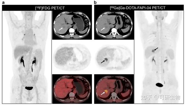 [68Ga]Ga-DOTA-FAPI-04 PET/CT---肿瘤研究新热点！ - 知乎