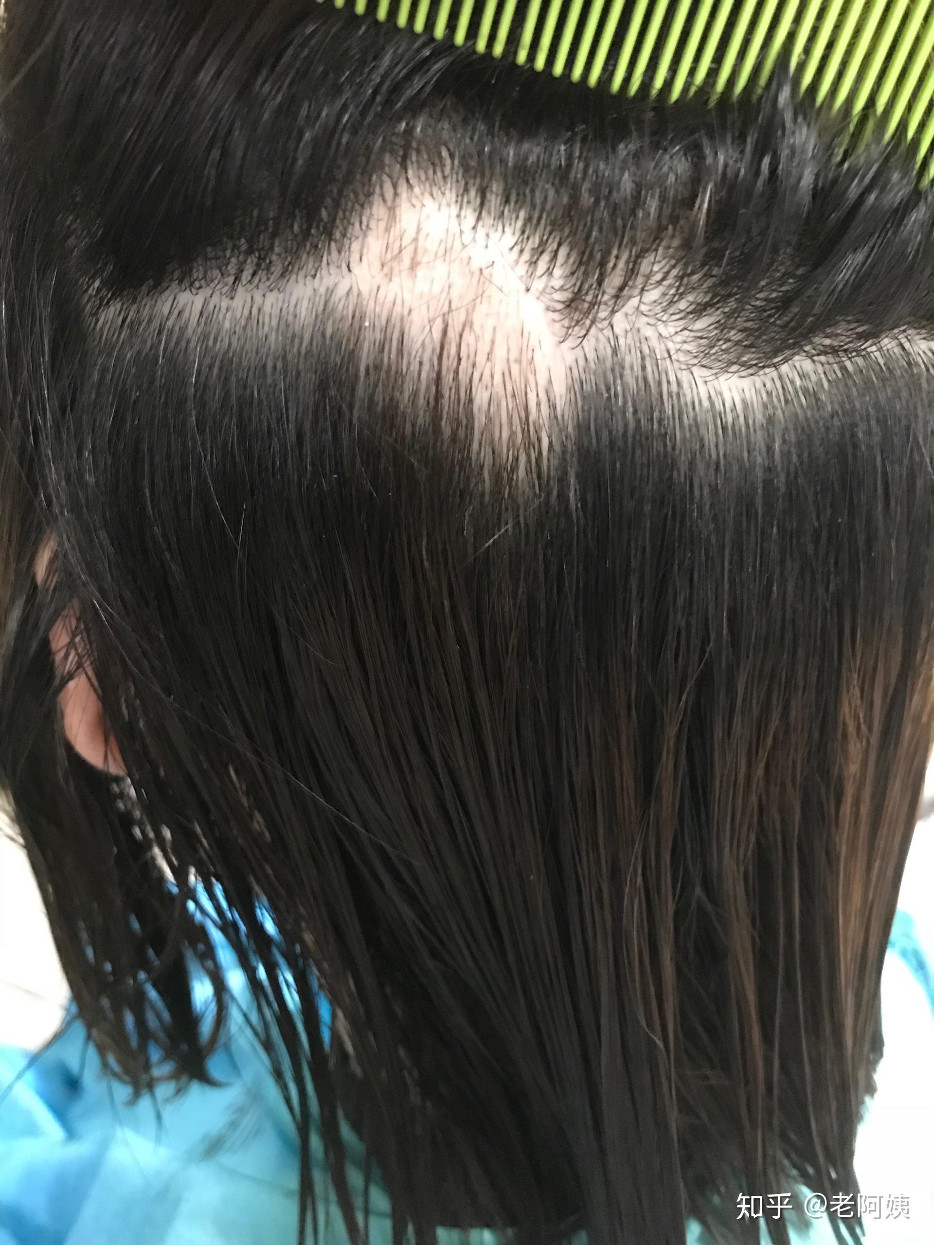 妙招巧用 生活大妙招 治疗斑秃 掉发 生发有诀窍! 知乎