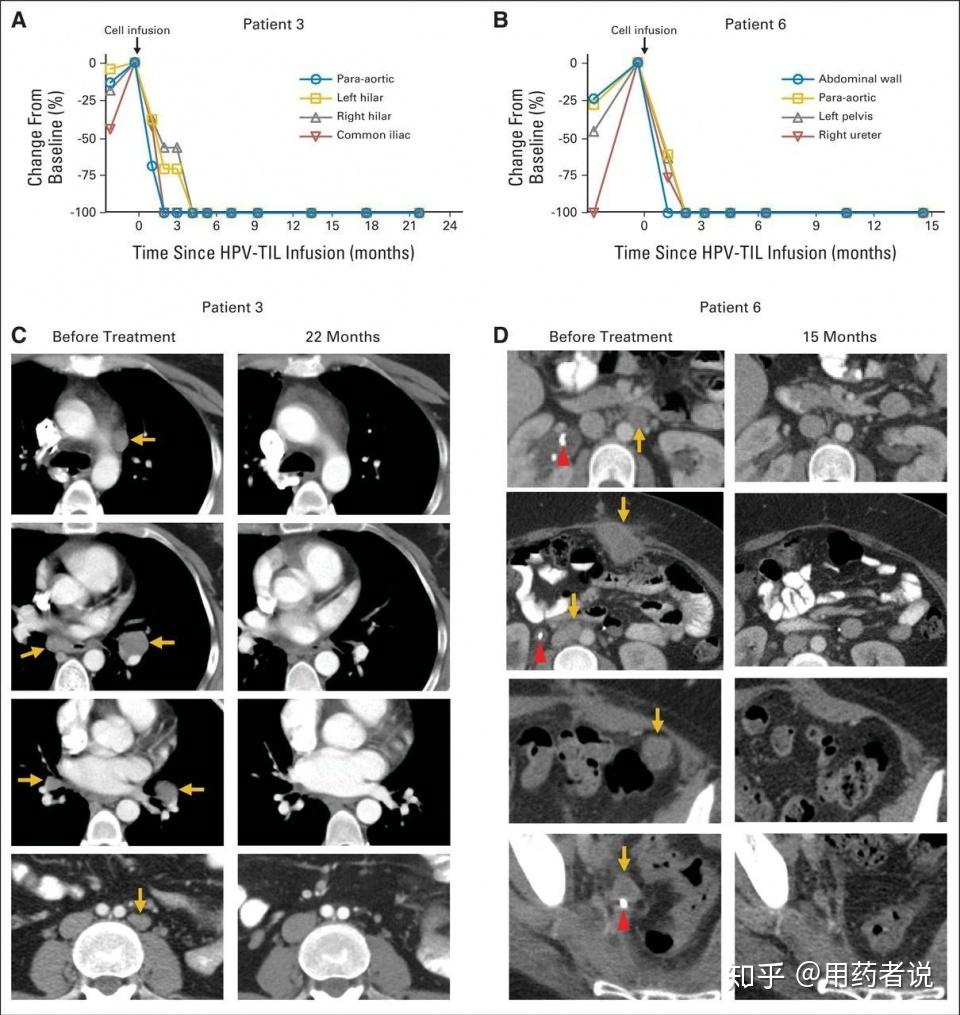 详细了解TILs疗法，正确选择肿瘤免疫治疗，不要“踩坑” - 知乎