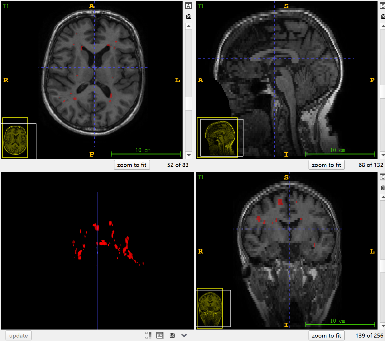 WMH 数据集介绍 - 知乎