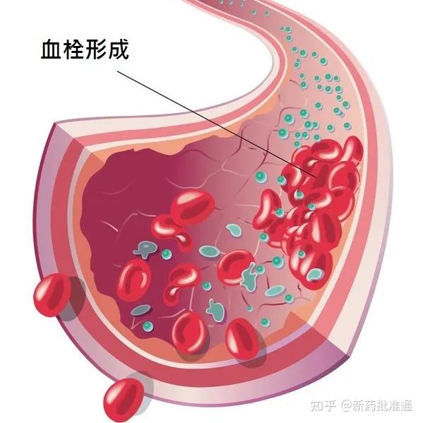 【FDA认定】历尽曲折，tecarfarin在抗凝血领域挑战华法林展现优势 - 知乎