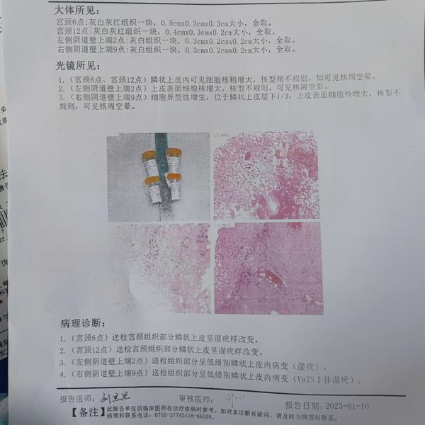 HPV 56阳性＋LSIL，检查和治疗全过程记录 - 知乎