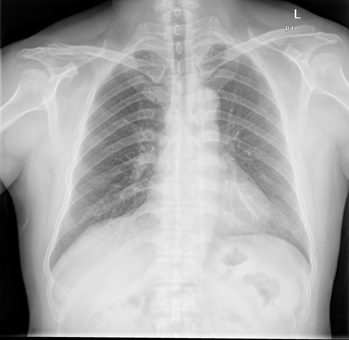 Shenzhen chest X-ray set 数据集介绍 - 知乎