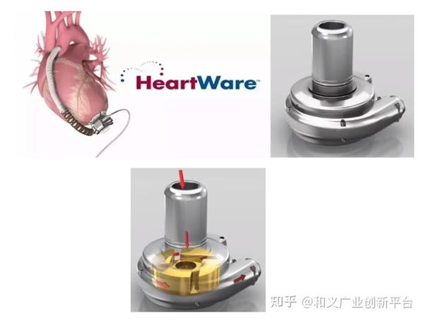 人工心脏3——盘点10家长期VAD产品 - 知乎